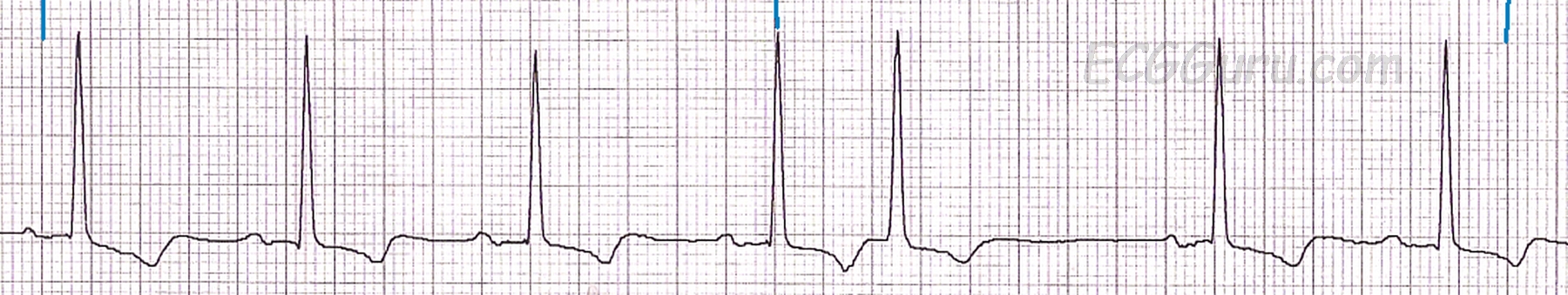 Atrial echo beat | ECG Guru - Instructor Resources